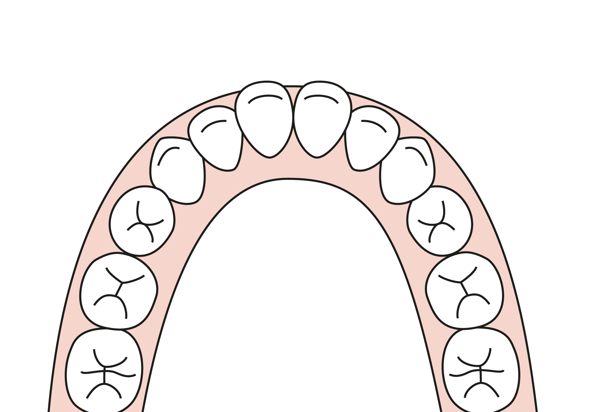 Narrow Upper Arch Care | Smilemore Orthodontics