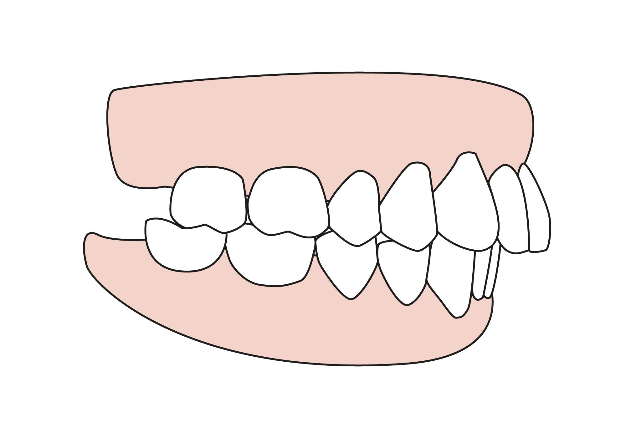 Deep Overbite Treatment South Australia | Smilemore Orthodontics